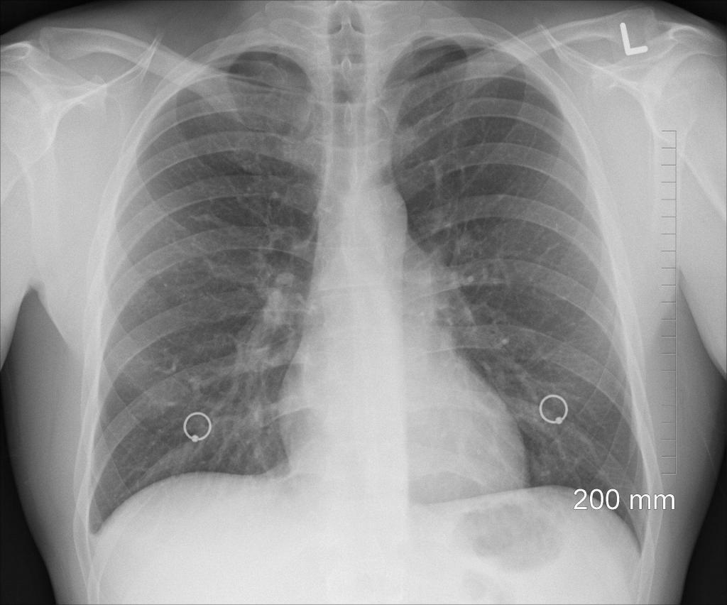 Asbestos in lungs | Symptoms and Treatments